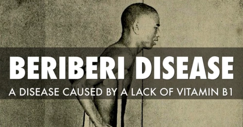 Beriberi: Nguyên Nhân, Dấu Hiệu & Cách Điều Trị