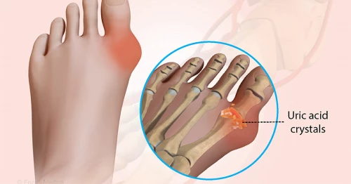 Gút (Gout): Nguyên Nhân, Triệu Chứng & Cách Điều Trị